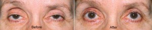 Upper Eyelid Ptosis Surgery for Droopy Eyelids | New York