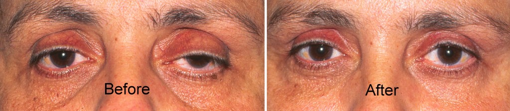 Upper Eyelid Ptosis Surgery for Droopy Eyelids | New York